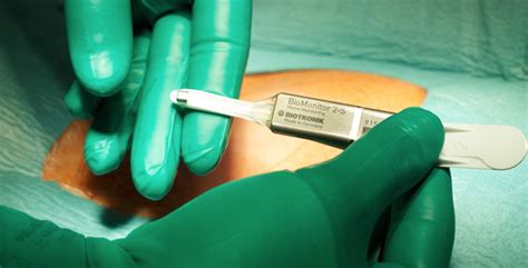 Abington Cardiologist First In State To Implant Special Heart Monitor