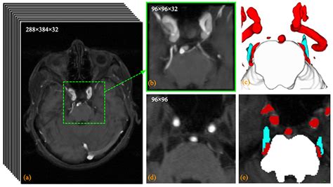 Frontiers Automated Segmentation Of Trigeminal Nerve And Cerebrovasculature In Mr Angiography