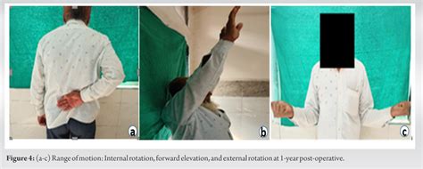 Recurrent Anterior Shoulder Dislocation With Coracoid Fracture In An Old Age Male A Rare Case