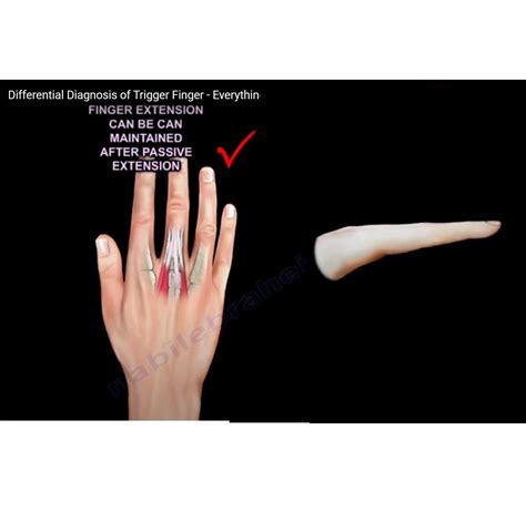 Differential Diagnosis Of Trigger Finger OrthopaedicPrinciples Com