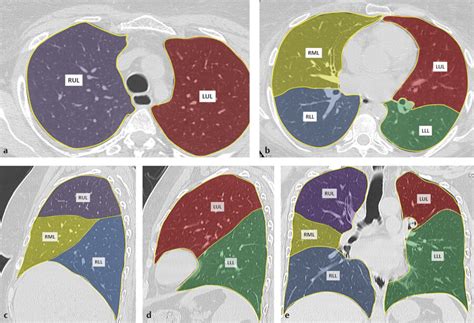 4 Lungs Radiology Key