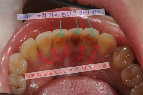 담배때문에 이빨이 시커매요누래요 무통스켈링과 담배니코틴착색 제거 에어플로우 주안 석바위 보인미소치과 네이버 블로그