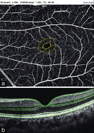 Automatic Segmentation Provided By Optical Coherence Tomography Download Scientific Diagram