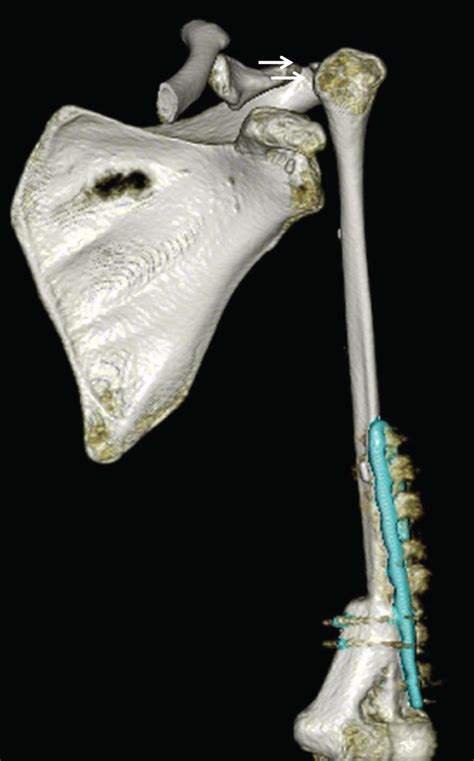 Postoperative 3d Ct Scan 3d Ct Scan Showing The Clavicle Scapula Download Scientific Diagram
