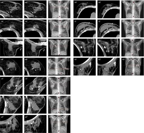 Contrast Enhanced Visualization Of The Tumor Cavity Following Download Scientific Diagram