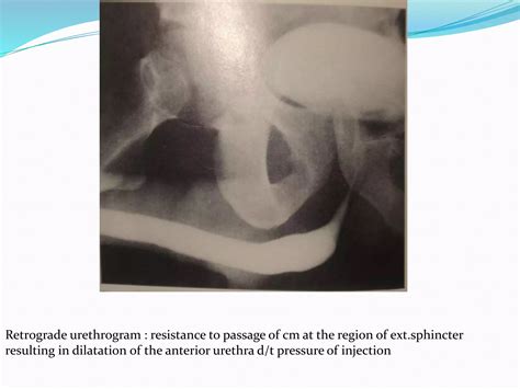 Antegrade And Retrograde Urethrogram Pptx Medical Tests Medical Health