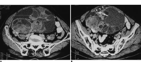 71 Year Old Woman With Left Mucinous Cystadenocarcinoma A Contrast
