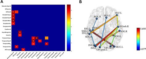 Functional Connectivity And Anxiety Improvement After Subthalamic Nucl
