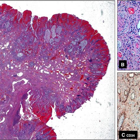 Macroscopic Specimen From Segmental Enterectomy Notorious Hemorrhagic Download Scientific