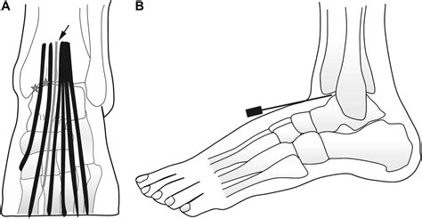 Mr Arthrography Of The Ankle Indications And Technique Radiologic