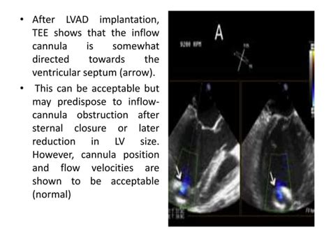 Lvad Left Ventricular Assist Device Echo Pptx