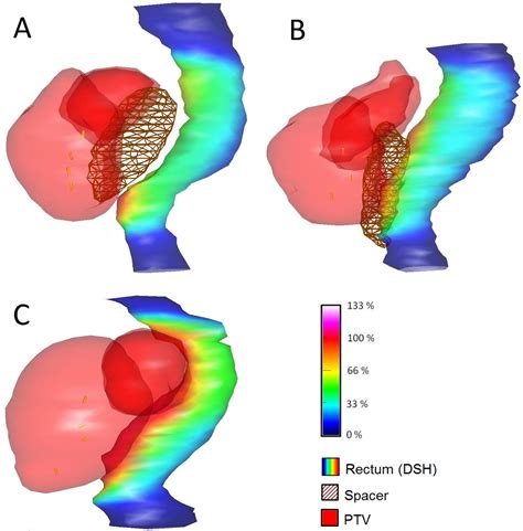 Comparison Of Two Different Rectal Spacers In Prostate Cancer External