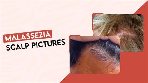 Malassezia Yeast On Scalp How To Reduce It Happy Cappy