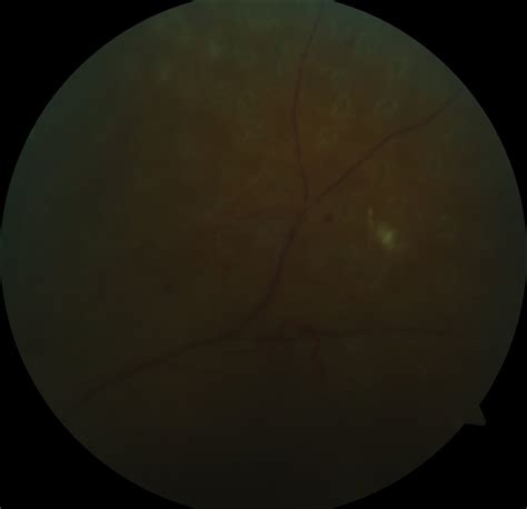 Diabetic Retinopathy Detection Object Detection Dataset And Pre Trained Model By Diabetic