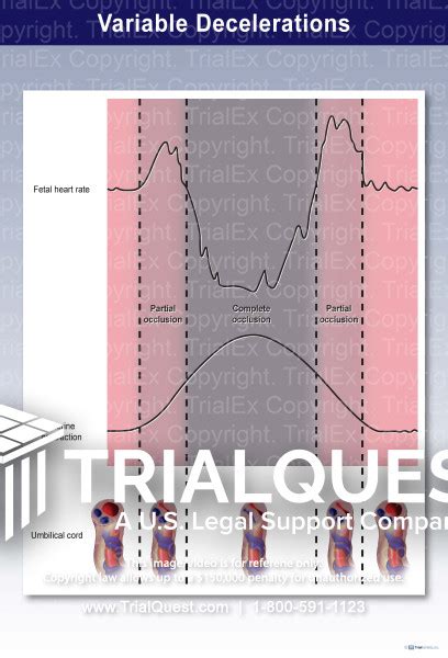Variable Decelerations Trialquest Inc