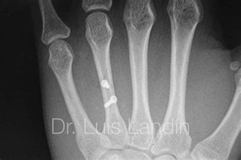 Fractura De Metacarpiano Dr Landín Dr Thione