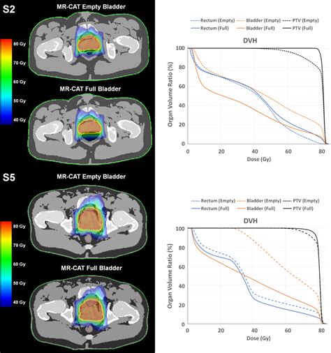 Left Synthetic Computed Tomography Ct Images With Dose Calculation Download Scientific