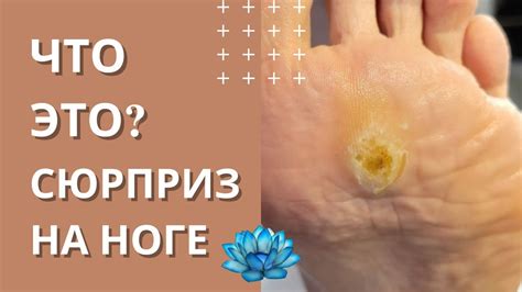 Что это Стержневая мозоль на ноге или бородавка на стопе Youtube
