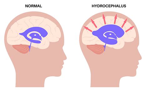 Normal Pressure Hydrocephalus Nph