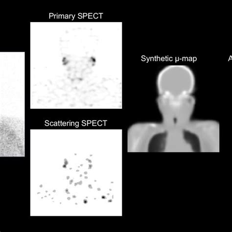 Ct Free Quantitative Thyroid Spect In A Patient With Thyroiditis Download Scientific Diagram
