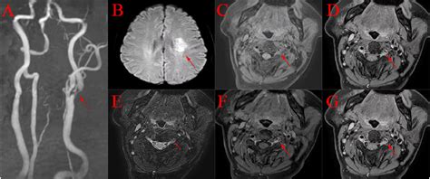 High Resolution Magnetic Resonance Vessel Wall Imaging In Ischemic
