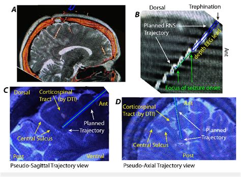 Stereotactic Planning A Sagittal Slice Through Fused Ct And Mri
