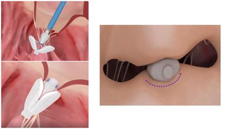 Minimally Invasive Mitral Valve Repair With The Pascal Device The Heart And Vascular Centre