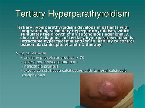 Ppt Hyperparathyroidism Powerpoint Presentation Free Download Id