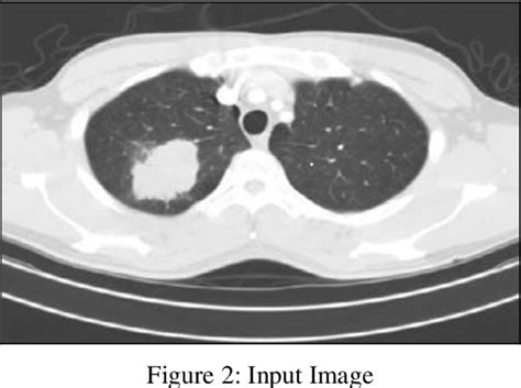 Figure 1 From Lung Cancer Detection Using Image Processing Semantic Scholar