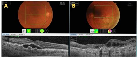 Swept Source Oct Topcon Image Ss Oct A Ss Oct Showed Right Eye Download Scientific