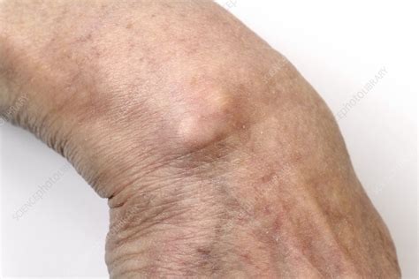 Large Ganglion Cyst On Wrist Ganglion Cysts Jlkxdl