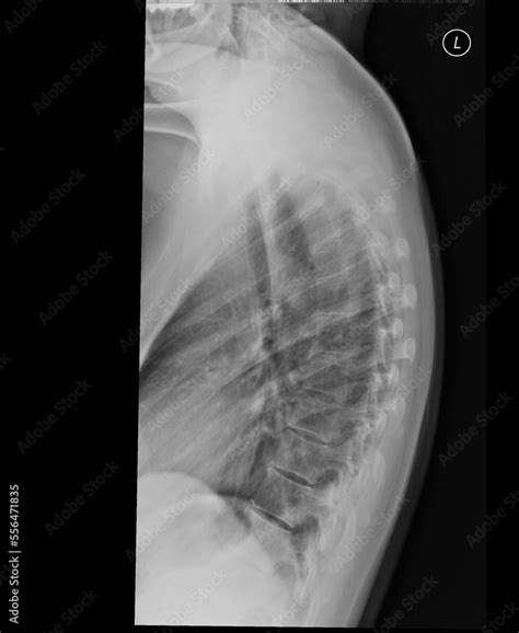 Thoracic Spine X Ray Lateral View A Kyphosis With Mild Right Convex