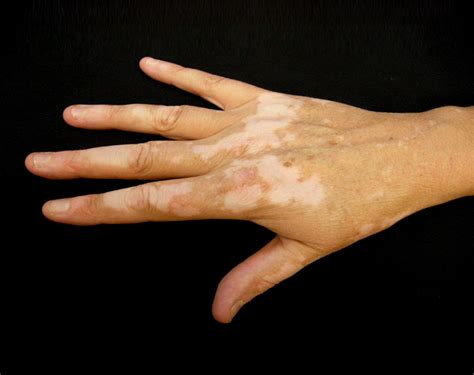 In Focus Vitiligo Medical Independent
