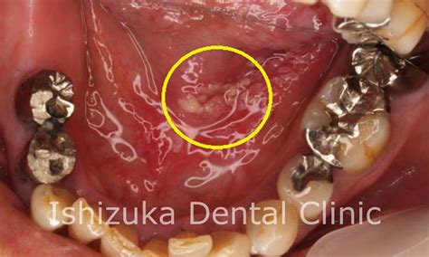 口の癌 口腔底癌