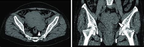 A Ct Scan Showed A Well Defined Mass Of Soft Tissue In The Left Adnexal Download Scientific