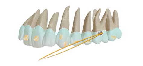 Elásticos De Clase Iii Con Alineadores ¿cómo Los Usamos Sas