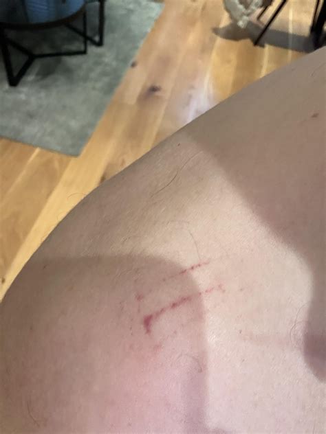 Keep Getting Random Scratch Like Marks But Are Not From Scratches On Shoulder Torso Area They