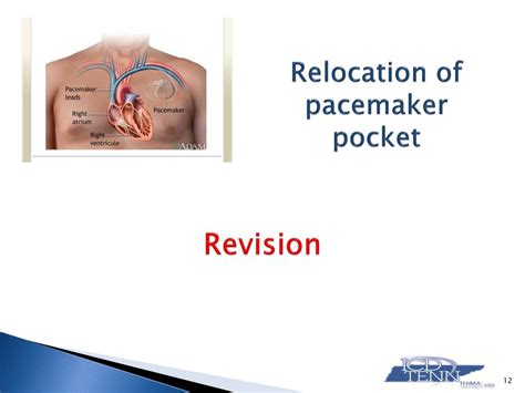 Ppt Introducing Icd 10 Pcs Root Operation Group 7 Powerpoint