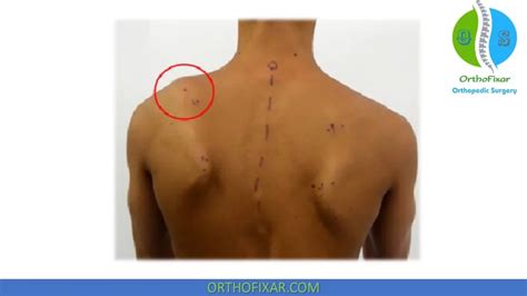 Scapular Dyskinesis Easy Explained Orthofixar 2025