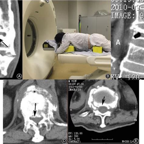 Comparison Of Vertebral Height And Posterior Bony Protrusion Before And