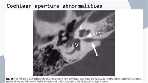 Pre Post Operative Imaging Of Cochlear Implantpptx