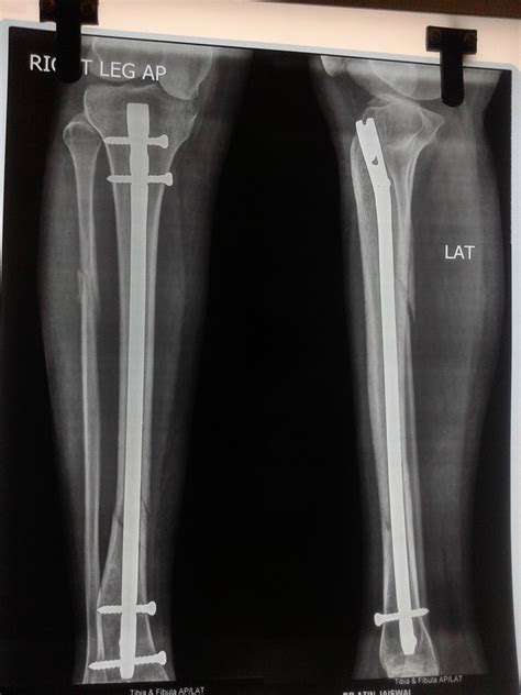 Fracture Lower End Tibia In Dr Atin Jaiswal Ms Ortho Facebook