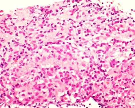 Biopsy Specimen Showing A Non Caseating Epithelioid Cell Granuloma Download Scientific Diagram
