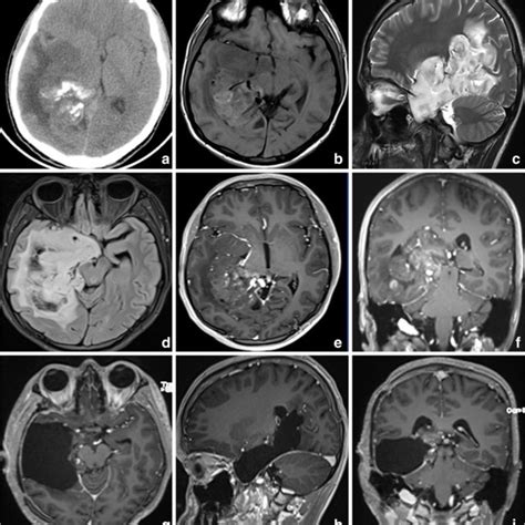 Ct Brain Plain Image A Shows A Large Hypodense Lesion Involving Right