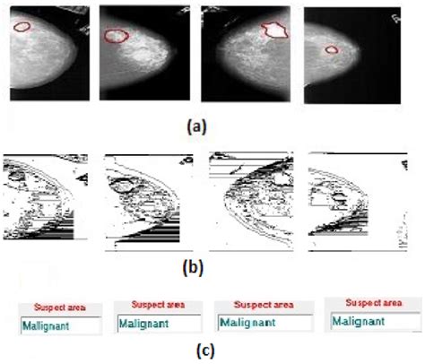 Microcalcification Detection In Mammograms Using Particle Swarm