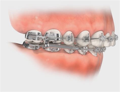 Braces Forsus Appliance At Violet Charette Blog