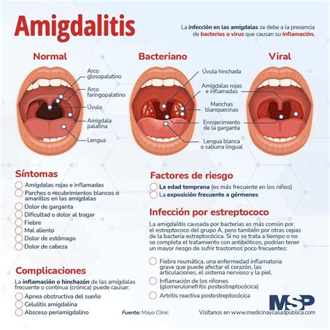 Amigdalitis Infografía En 2025 Cosas De Enfermeria Amigdalitis