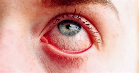 Deadly Eye Bleeding Virus Which Kills Up To A Third Of Patients Reaches Europe World News