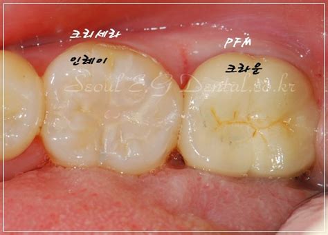[어금니 충치치료] 어금니의 크고 작은 충치 인레이 크라운 치료 사례 충치치료 Dr 이재용의 개인홈페이지