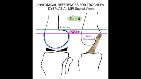 Anatomical References For The Assessment Of Trochlear Shape Youtube